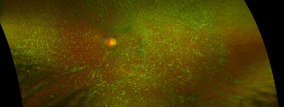 Retina Orange County